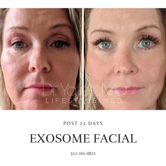 Exosome Facial Treatments – Dr Yates MD