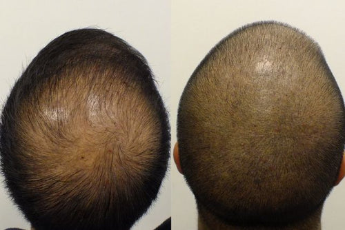 SCALP MICRO PIGMENTATION – Dr Yates MD