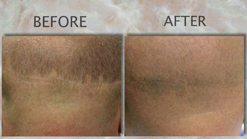 SCALP MICRO PIGMENTATION – Dr Yates MD