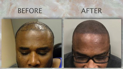 SCALP MICRO PIGMENTATION – Dr Yates MD