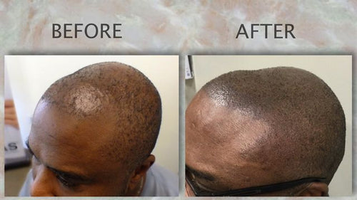 SCALP MICRO PIGMENTATION – Dr Yates MD