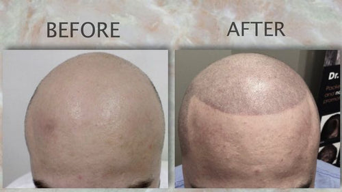 SCALP MICRO PIGMENTATION – Dr Yates MD