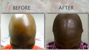 SCALP MICRO PIGMENTATION – Dr Yates MD