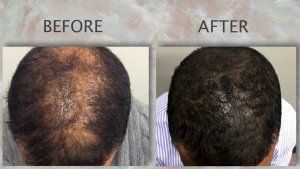 SCALP MICRO PIGMENTATION – Dr Yates MD
